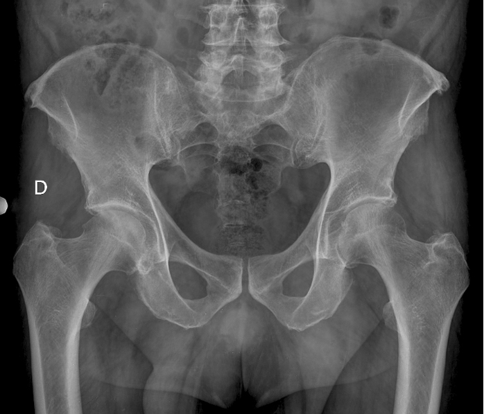 Map Quiz: Imagen Rx - Pelvis AP - Fácil (rx - rx pelvis)