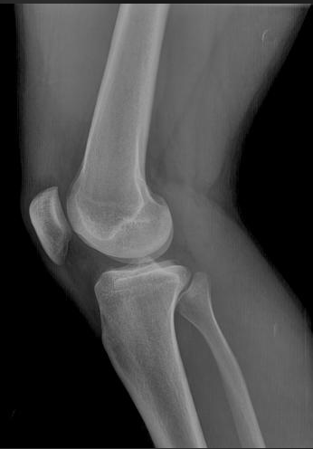 Mapa Interactivo: Imagen Rx - Rodilla lt - Fácil (rx - radiología - rx ...