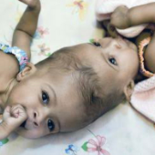 Matching Pairs: Gemelismo (gemelismo - siameses - parásitos)