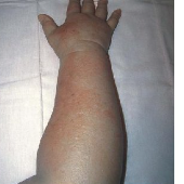 Matching Pairs: Complicaciones de la terapia intravenosa (flebitis - complicaciones - intravenosa)