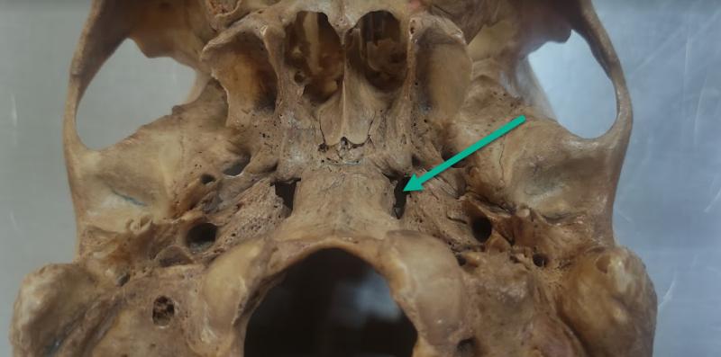 Quiz: CRANEO (Formación de personal - endocraneo - craneo - anatomia)