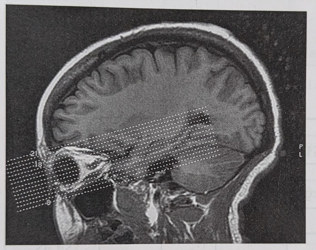 Matching Pairs: MRI Pituitary, IAC's, Orbits, MS, Temporal Lobe, and ...