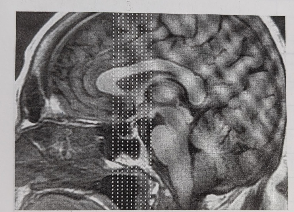 Matching Pairs: MRI Pituitary, IAC's, Orbits, MS, Temporal Lobe, and ...