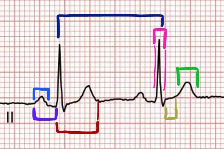 Mapa Interactivo: Primero identifica las partes del ECG ...