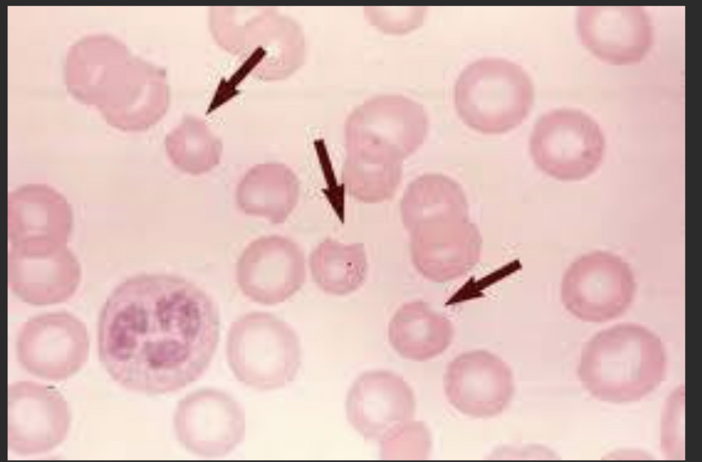 Relacionar Columnas: HEMA: POIKILOCYTE RBC