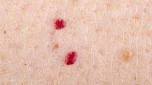 Matching Pairs: Skin Lesions